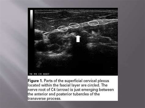 25820 Cervical Plexus Block 1 Pptx
