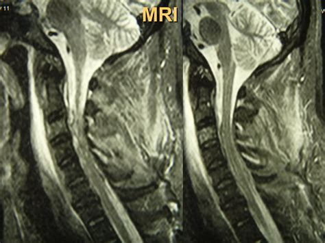 Epidural And Subdural Abscess Ppt