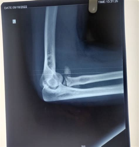 1st Case Of Radial Head Excision Arthroplasty And Replacemnt With Dr