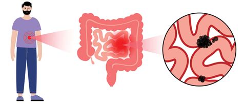 Gastrointestinal Stromal Tumors Gists The Unique And Mysterious