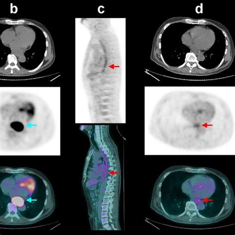In The Group Of Patients With Esophageal Squamous Cell Carcinoma Who