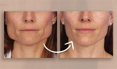 Masseter Botox Pro Age Clinic Uae