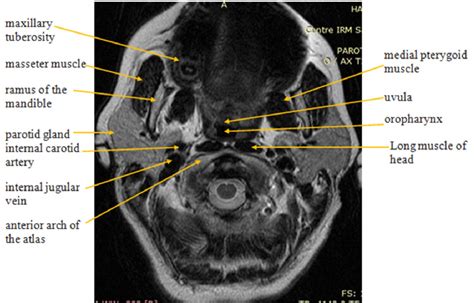Crosssectional Imaging Of Parotid Gland Nodules A Brief Practical