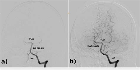 Cerebral Angiogram Of The Left Vertebral Artery Cerebral Angiogram