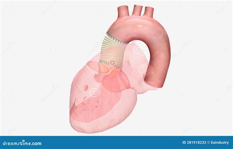 The Enlarged Portion Of The Aorta Is Replaced With A Synthetic G Stock Illustration
