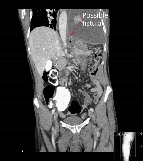 Radiopaedia Case Pancreaticopleural Fistula In Pancreatitis Id 98619