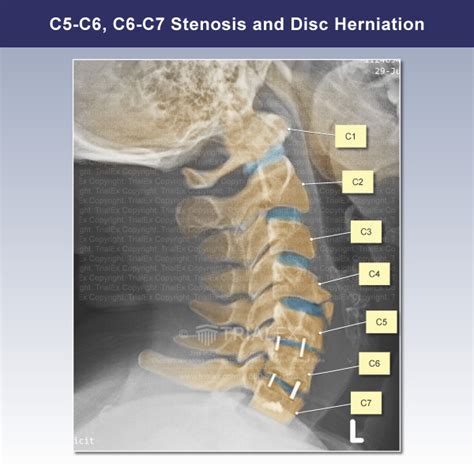 Medical Legal Exhibits Legal Animations And Trial Graphics