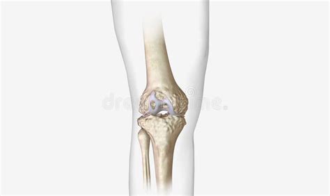 Post Traumatic Arthritis In Knee Stock Illustration Illustration Of