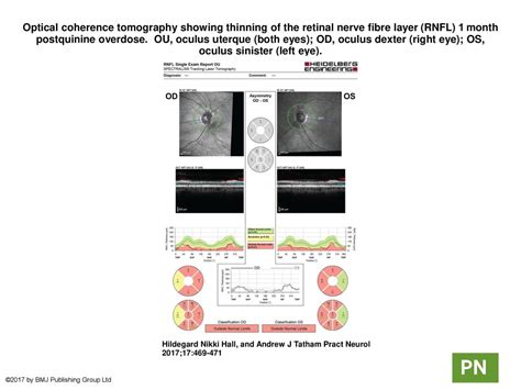 Optical Coherence Tomography Showing Thinning Of The Retinal Nerve Fibre Layer Rnfl 1 Month