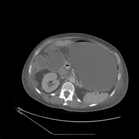 Fileesophageal And Gastric Pneumatosis Portal Venous Gas Radiopaedia