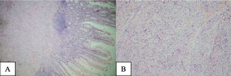 Photomicrographs Of Leiomyosarcoma A Infiltrative Atypical Spindle