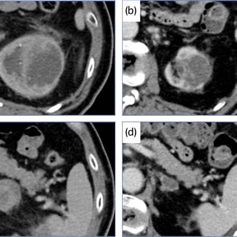 Ct Images In Case 1 There Is A Right Renal Mass On Initial Diagnosis