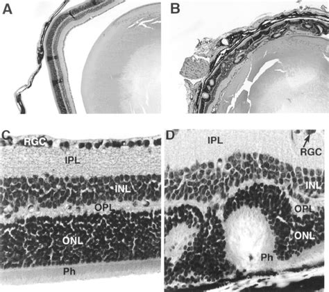 Oligodendrocyte Precursor Hypercellularity And Abnormal Retina