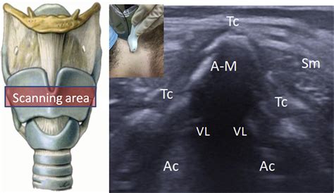 Ultrasound For Assessment And Follow Up Of Airway Stenosis The Annals
