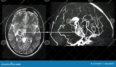 Brain Angiography Ct Scan Reconstruction Malformation Royalty Free