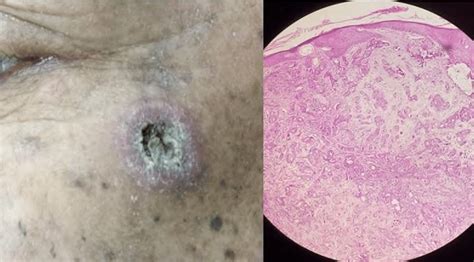 A Case Of Clinically Suspected Of Keratoacanthoma Which Download