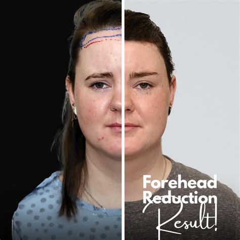 Forehead Reduction Before And After Photos Unfiltered Results