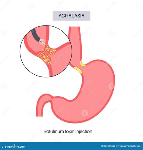 Esophageal Botulinum Toxin Injection Vector Illustration