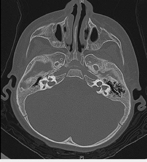 Ct Temporal Bone Axial Cut Showing Patent Bilateral Internal Auditory