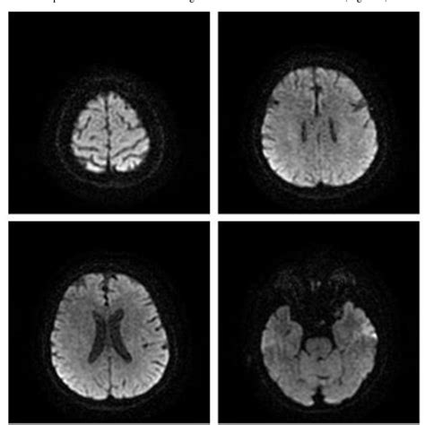 Figure 1 From A Rare Case Of Bickerstaffs Brainstem Encephalitis