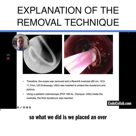 Video Endocollab™ Gi Endoscopy Education On Linkedin Explanation