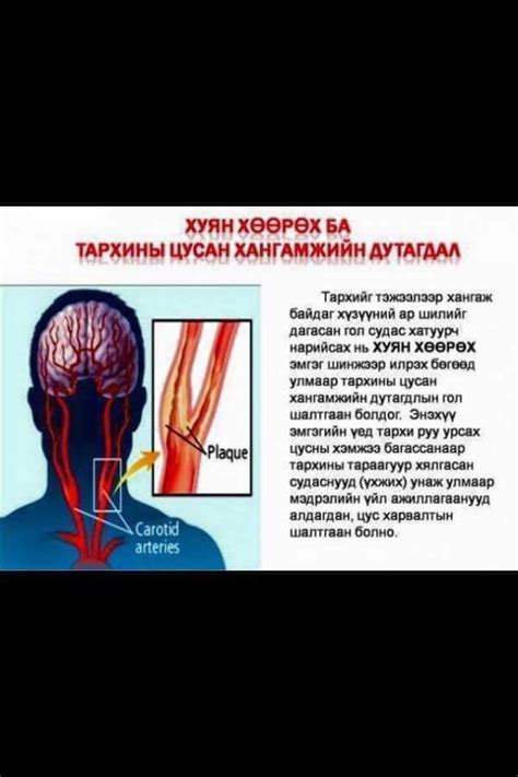 БЗД дахь Аарцаг БЗД дахь Аарцаг нурууны бариа заслын төв