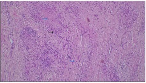 Pseudorheumatoid Nodules In A Young Woman Indian Journal Of Dermatology Venereology And Leprology