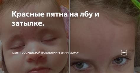 Красные пятна на лбу и затылке Центр сосудистой патологии