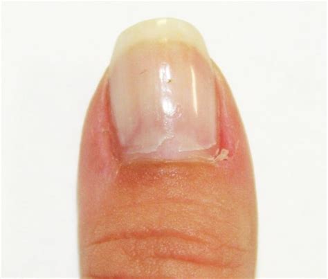 Hangnails Encyclopedia Nails Magazine