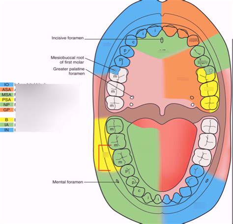Types Of Maxillary Anesthesia At Matthew Alvarez Blog
