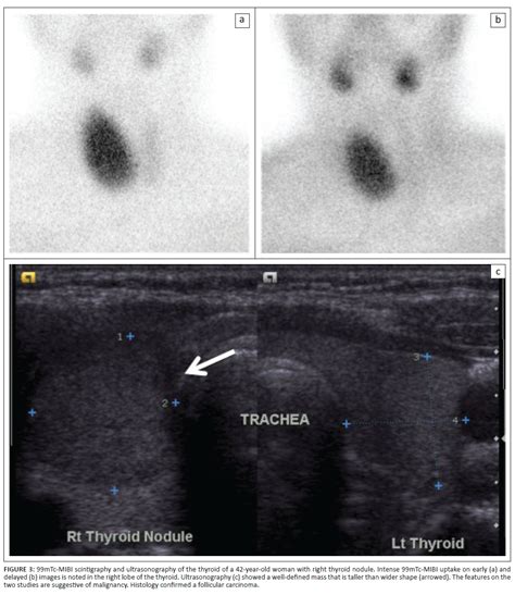 Evaluation Of Hypofunctioning Thyroid Nodules With Technetium 99m Mibi