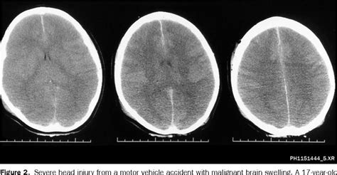 Brain Swelling After Concussion