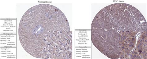 The Expression Of Cenpl Protein In Tumor And Normal Tissues
