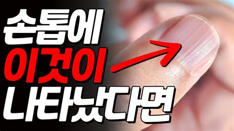 암이 생기기전 손톱에 나타나는 5가지 징조 Youtube