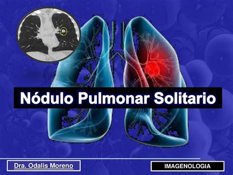 Nódulo Pulmonar Não Calcificado 0 5 Cm Retoedu