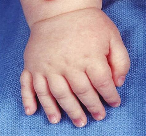 Deformities Of The Hand And Fingers Clinical Tree
