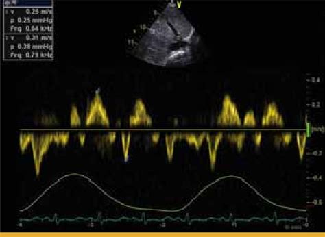 Hepatic Venous Pw Doppler Assessment In A Patient With Cp The Hepatic