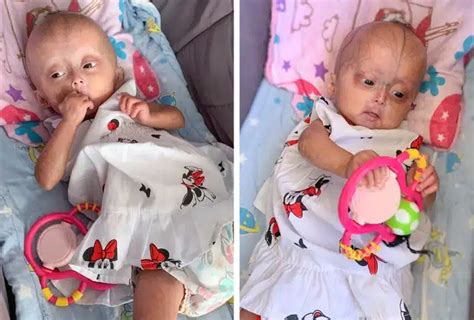 Benjamin Button Syndrome Meet The Rare Twins Who Have It