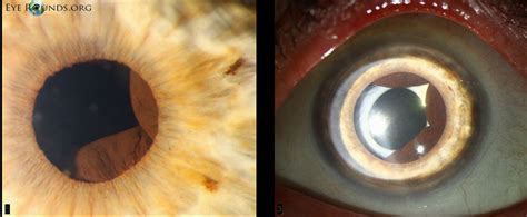 Atlas Entry Iris Pigment Epithelialcysts