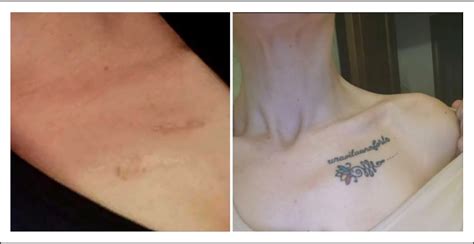 Figure From Impact Of Totally Implanted Venous Access Port Placement On Body Image In Women