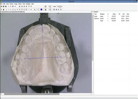 Calculating The Angle Formed Between The Incisal Edge Of The
