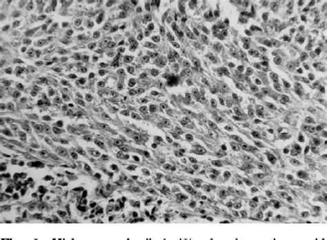 Figure 3 From Dermatofibrosarcoma Protuberans Of Scalp With Cervical Lymph Node Metastasis