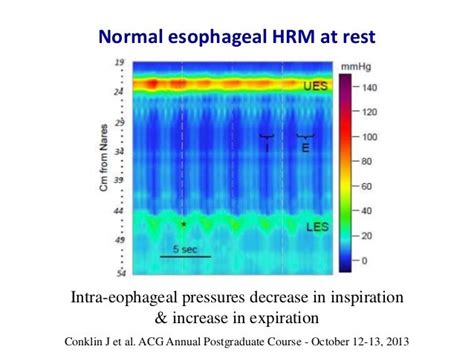 Nutcracker Esophagus Manometry