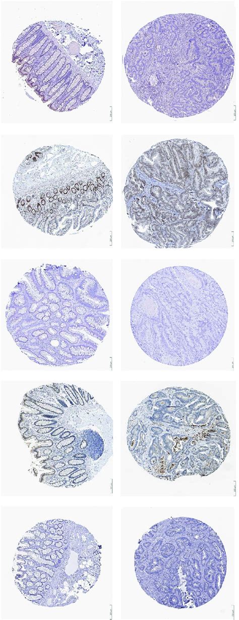 The Protein Expression Of Risk Model Genes In Coad And Normal Colon