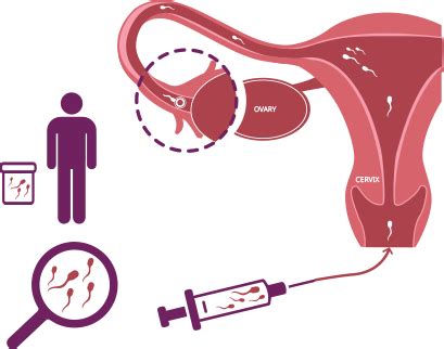 IUI Services In Pimpri Chinchwad IUI Treatment Cost Pune