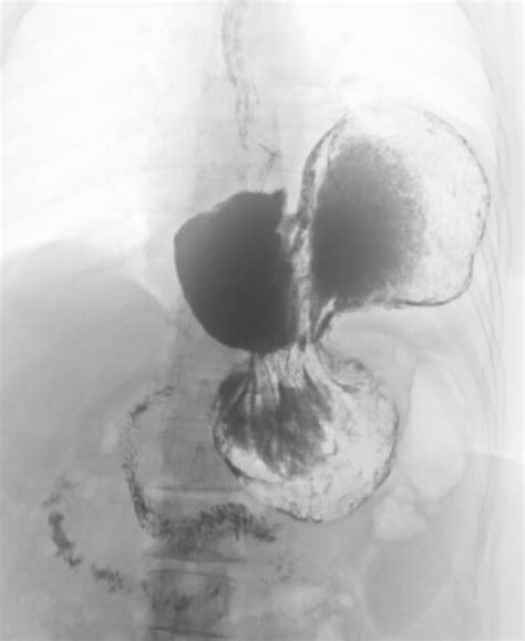 Gastric Volvulus Radiology Assistant At Lindsay Mullen Blog