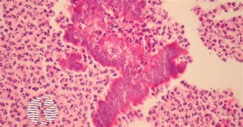 Botryomycosis Pathology Image