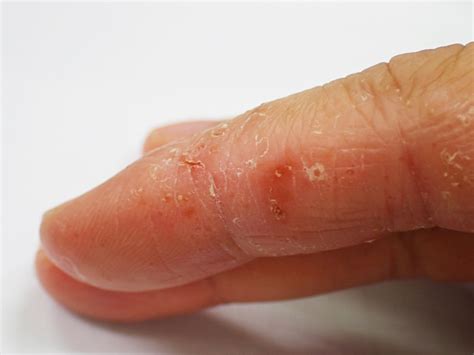 What Is Dyshidrotic Eczema Balmonds