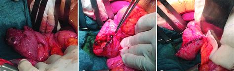 Gist Of The 2nd 3rd Duodenal Portion A Duodenal Wall After Gist