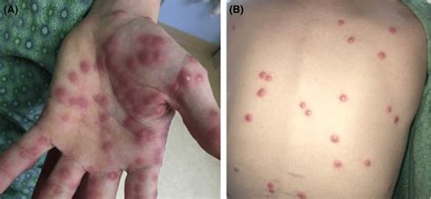 A Palmar Surface Of Left Hand Demonstrating Diffuse Violaceous